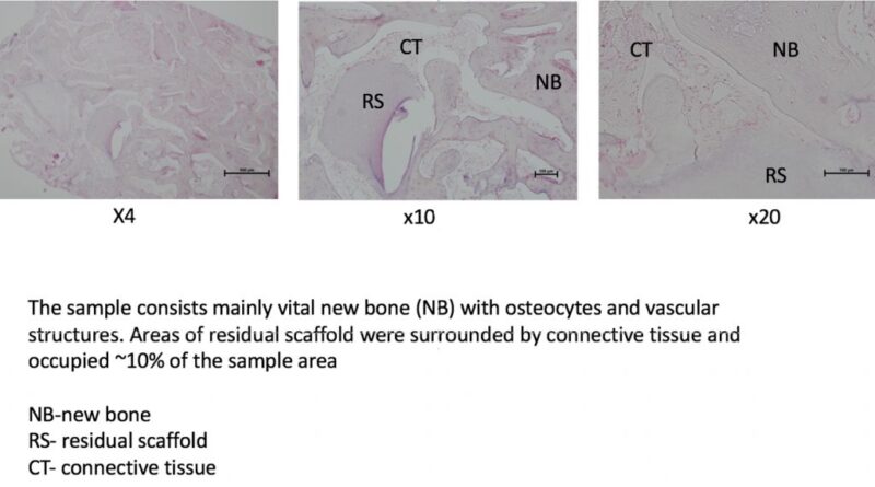 The Biologic Effects of Bond Apatite® in New Bone Formation in Osseous ...