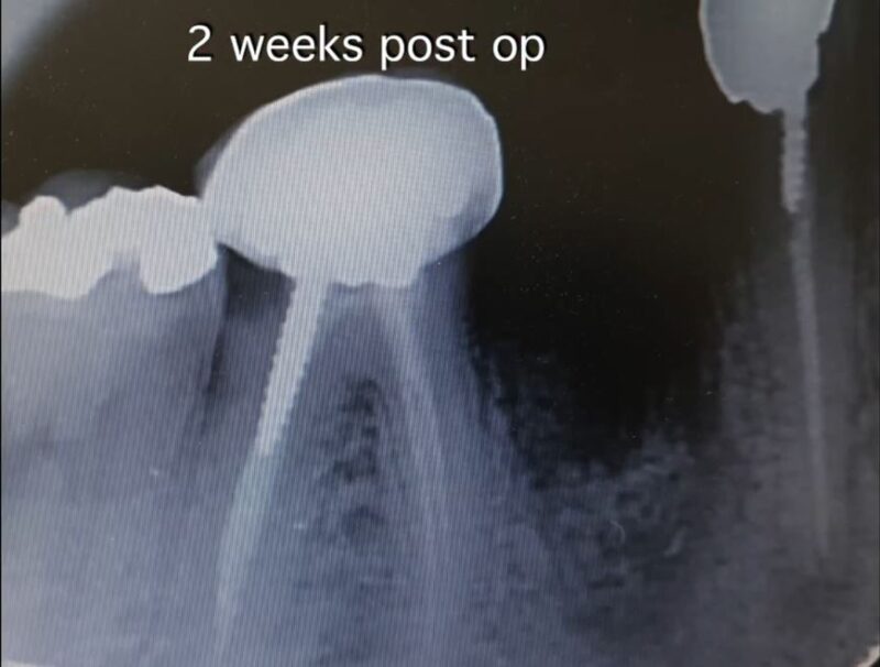 What to Expect - Soft Tissue Healing - Augma Biomaterials