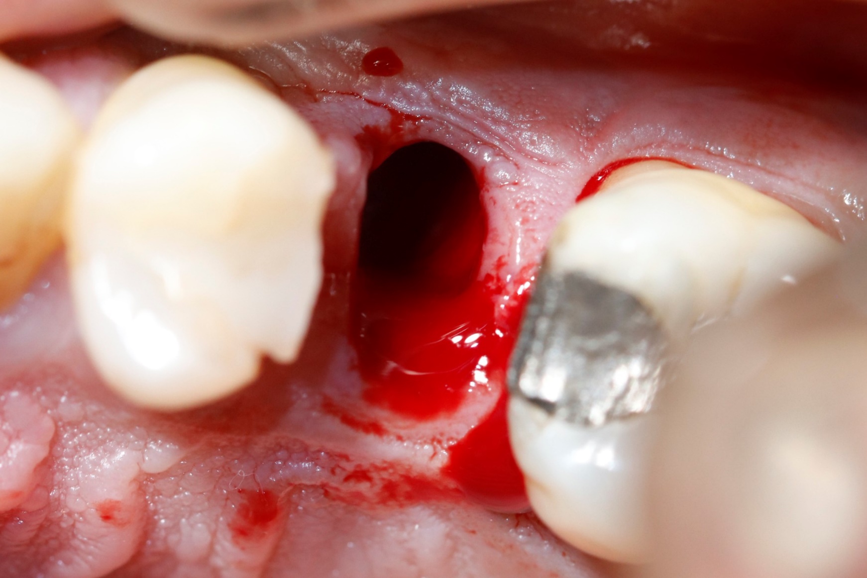 What to Expect - Soft Tissue Healing - Augma Biomaterials