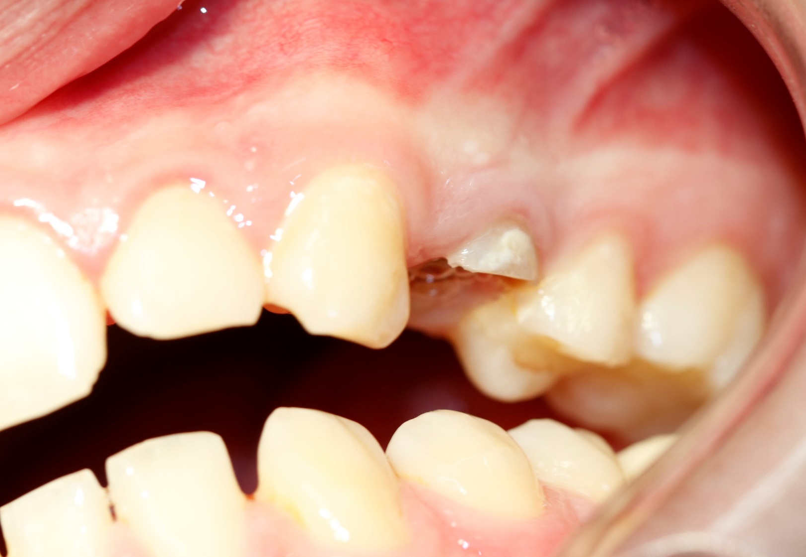 What to Expect - Soft Tissue Healing - Augma Biomaterials