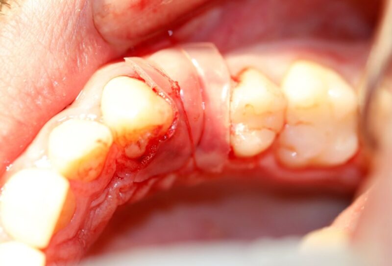 What to Expect - Soft Tissue Healing - Augma Biomaterials