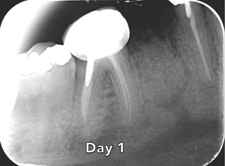 What to Expect - Soft Tissue Healing - Augma Biomaterials