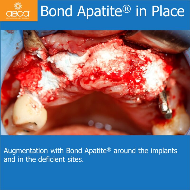 Lateral Augmentation - 2 mm ridge - Augma Biomaterials