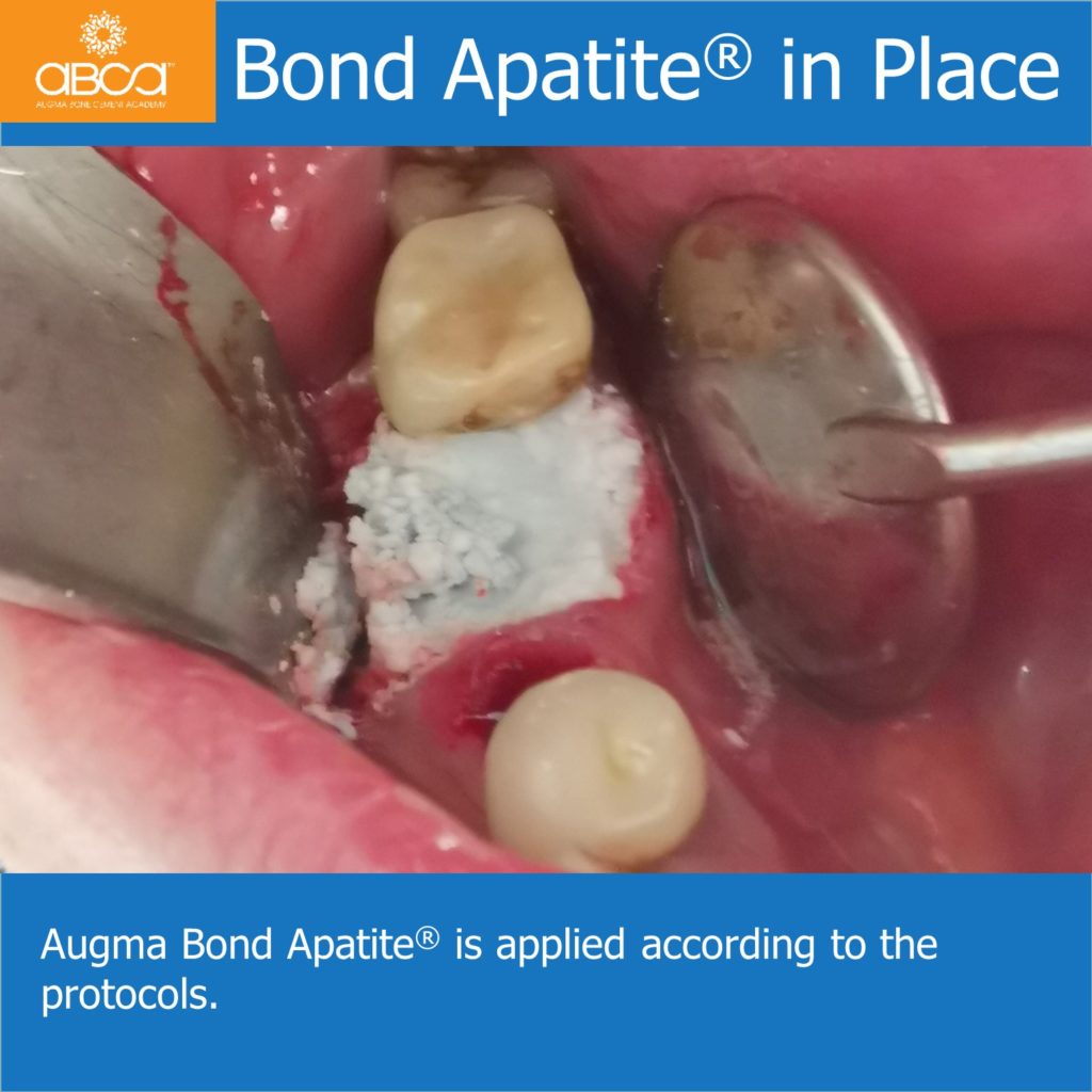 Cyst Enucleation, Augma & Implants - Augma Biomaterials