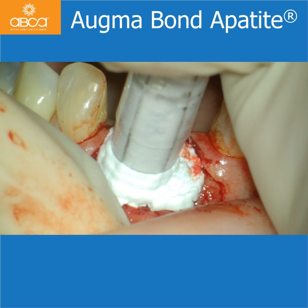 Upper Central Incisors, Augmentation & Implants - Augma Biomaterials
