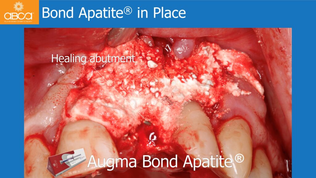 Implant in the Aesthetic Zone with Bone Reconstruction and Immediate ...