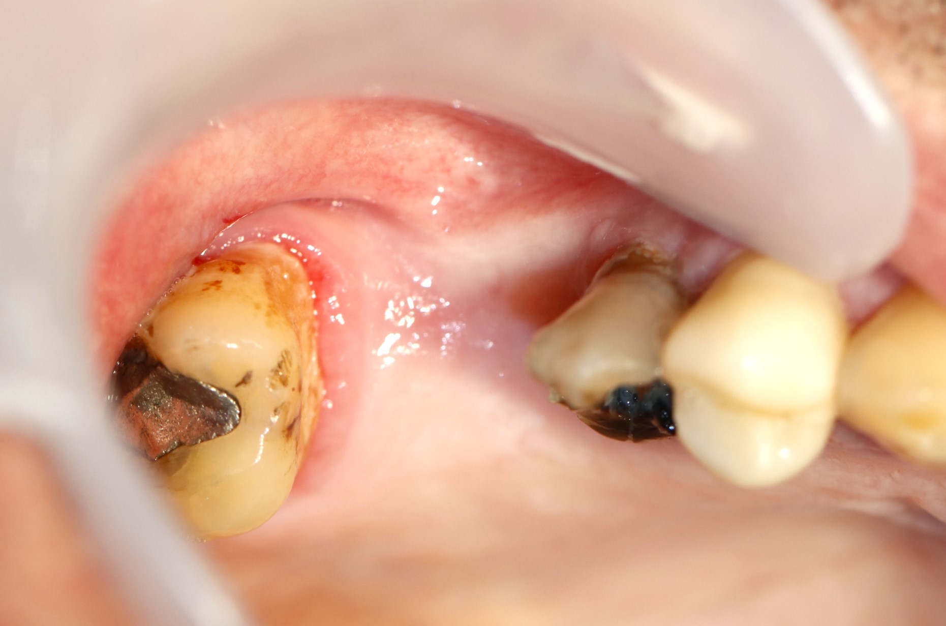 What to Expect Augma Lift™ - Augma Biomaterials