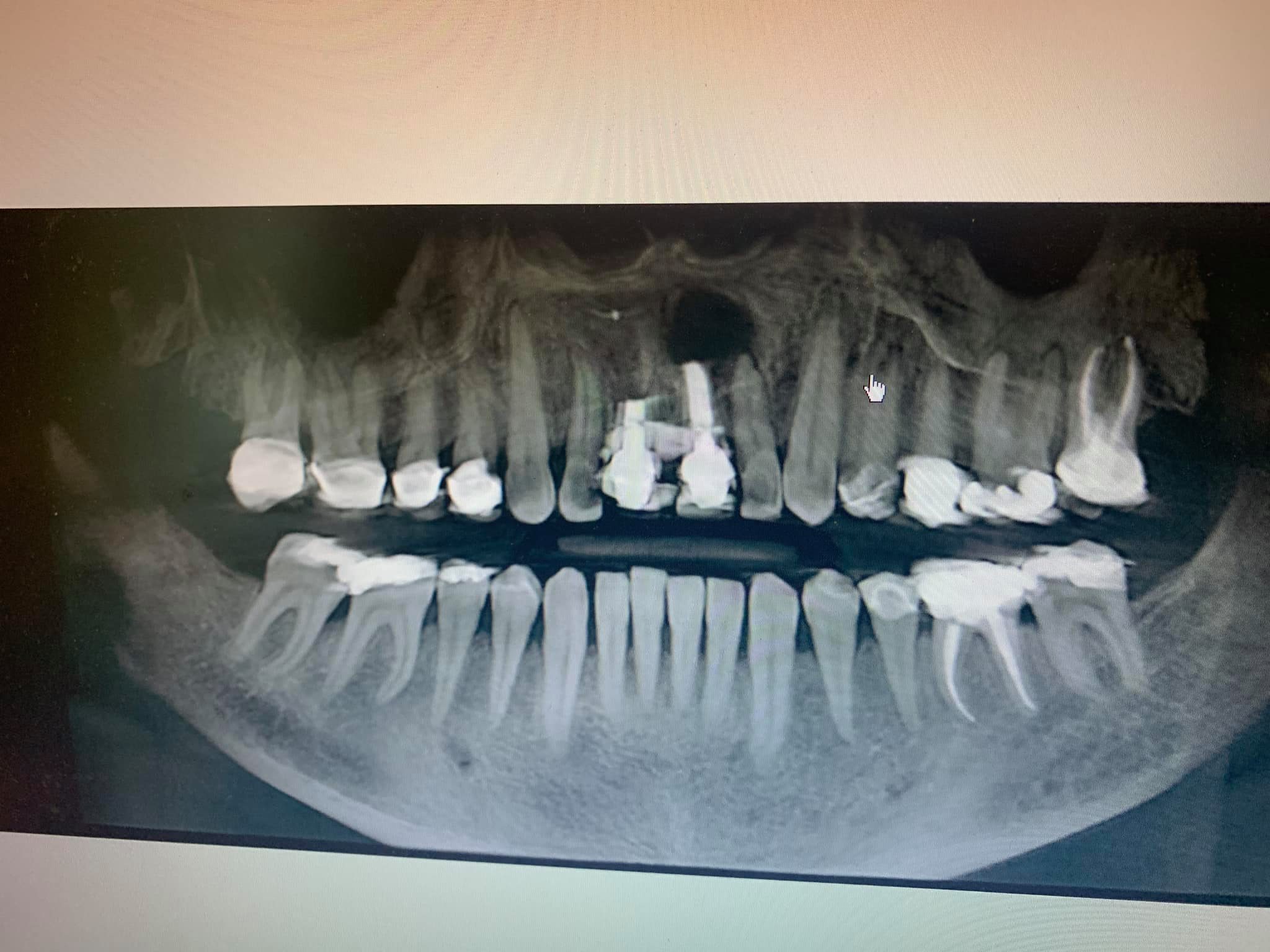 Bone Reconstruction after Cyst Removal - Augma Biomaterials
