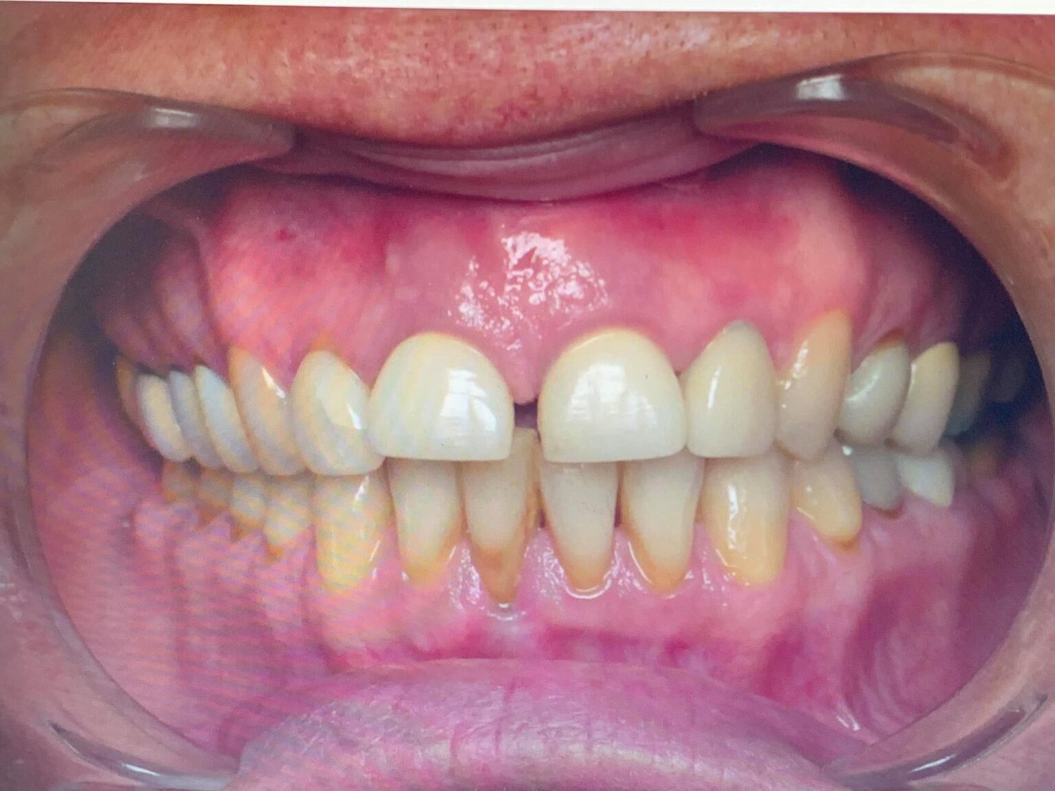 Bone Reconstruction after Cyst Removal - Augma Biomaterials