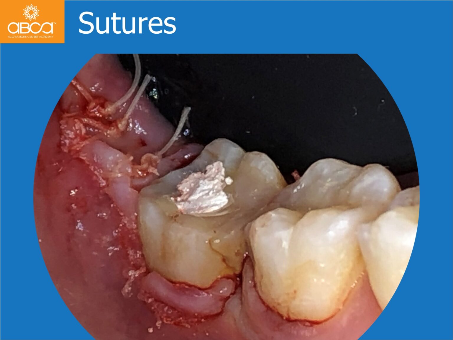 Second Molar Stabilization Following Wisdom Tooth Extraction with Augma ...