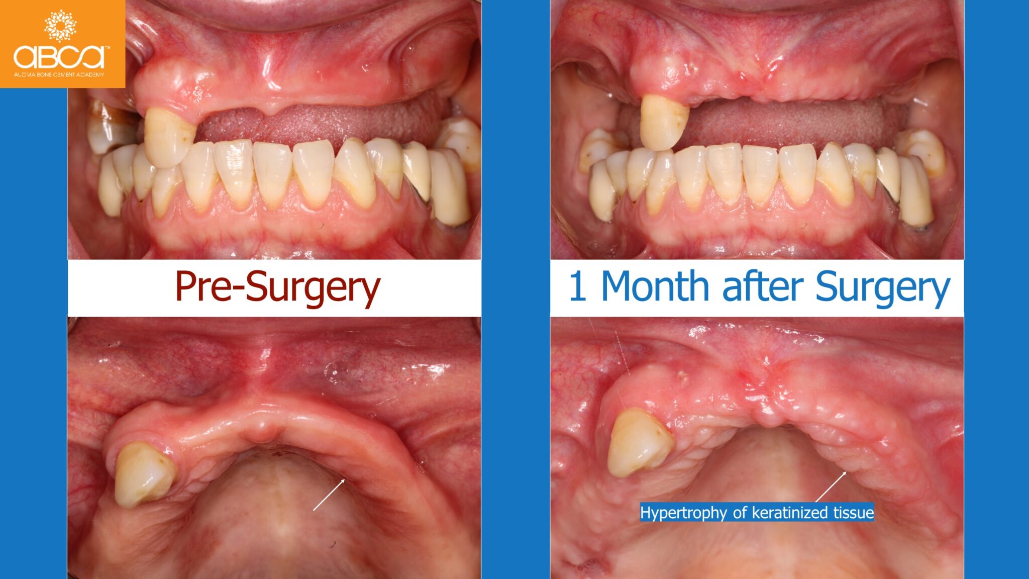 2 Phase Total Maxillary Rehabilitation with Bone Reconstruction and an ...