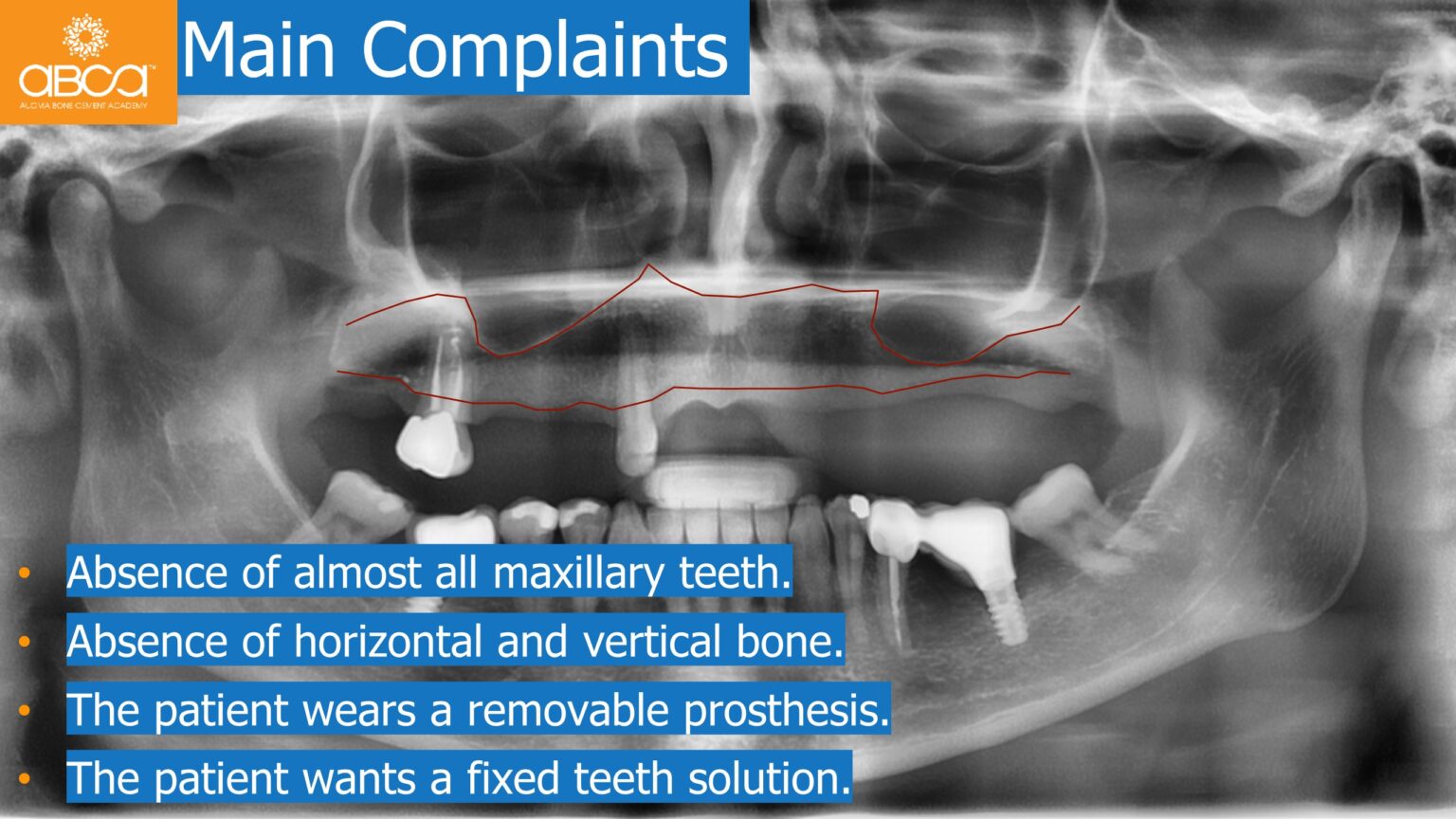 2 Phase Total Maxillary Rehabilitation with Bone Reconstruction and an ...