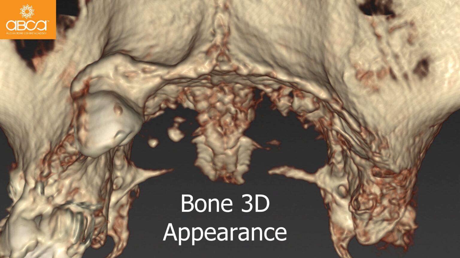 2 Phase Total Maxillary Rehabilitation with Bone Reconstruction and an ...