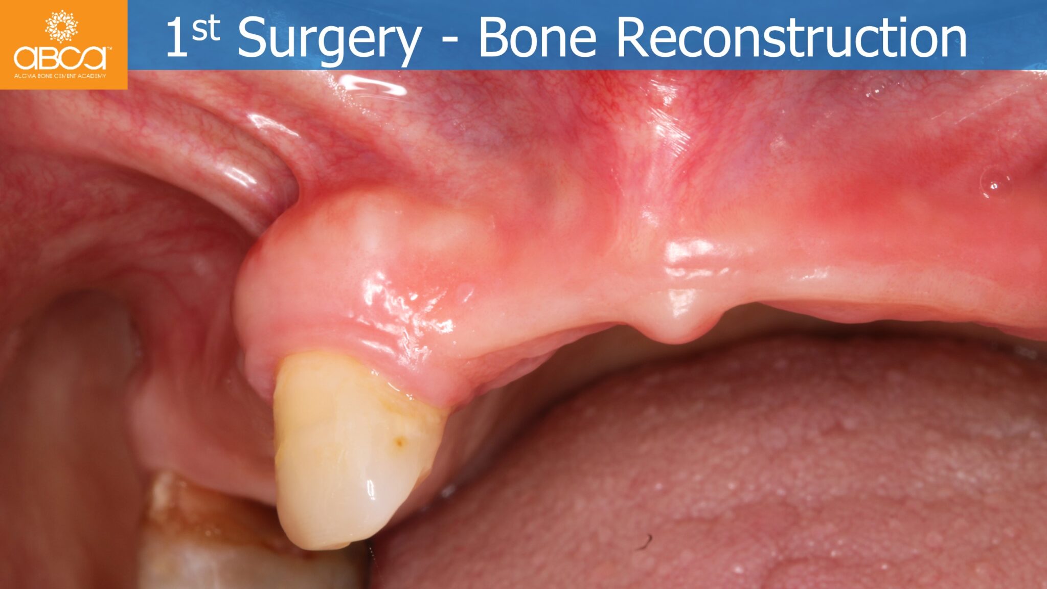2 Phase Total Maxillary Rehabilitation with Bone Reconstruction and an ...
