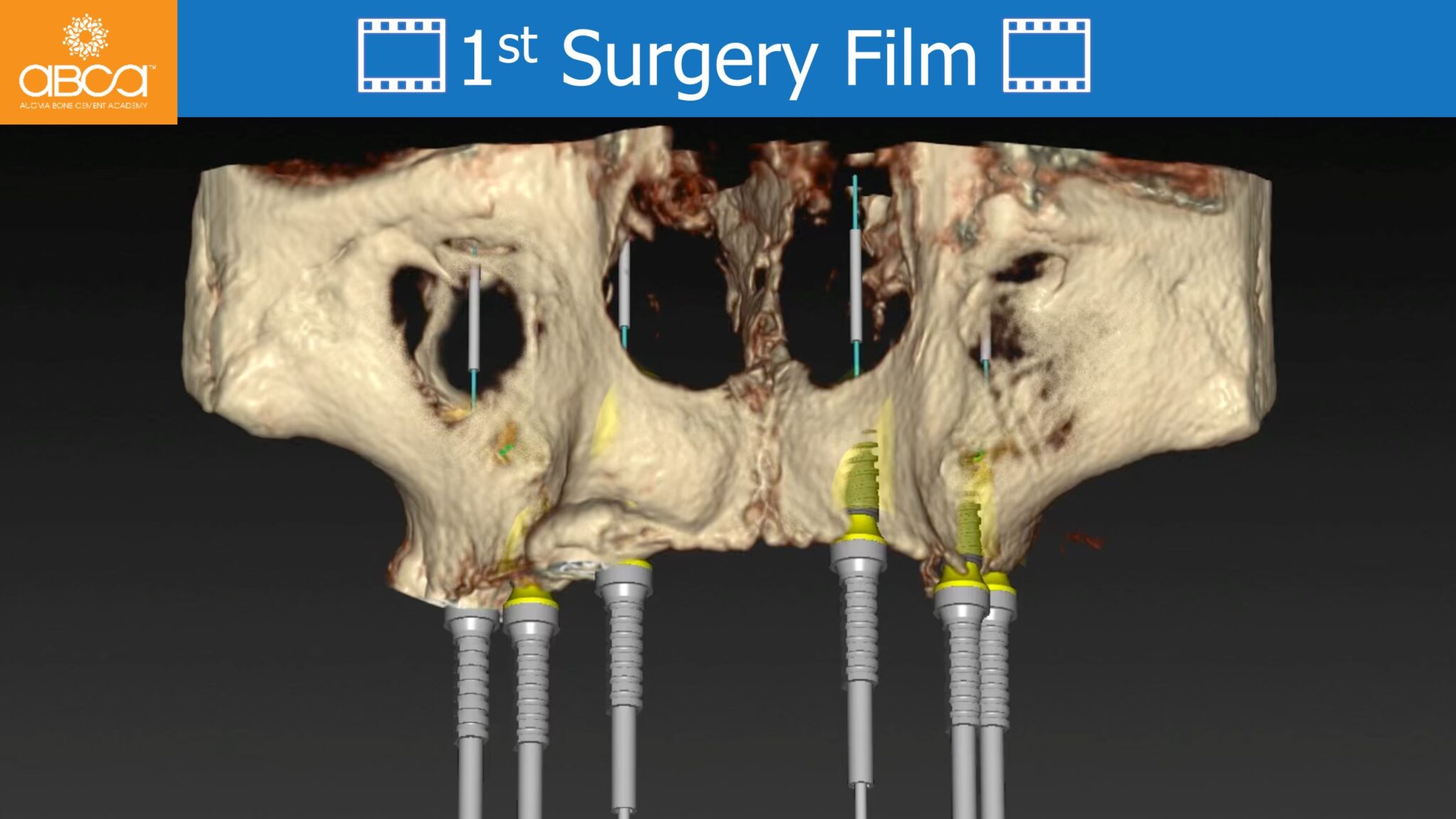 2 Phase Total Maxillary Rehabilitation with Bone Reconstruction and an ...
