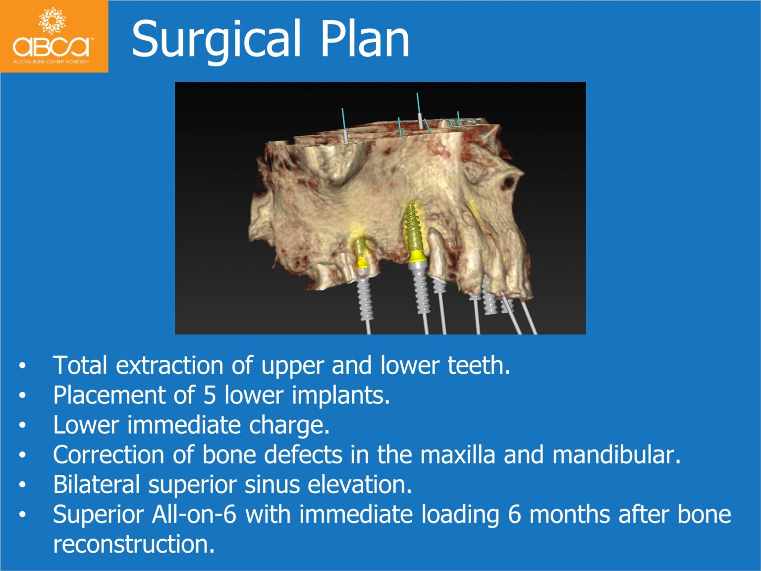 Complete Oral Rehabilitation Part 2-Maxillary Augmentation - Augma ...