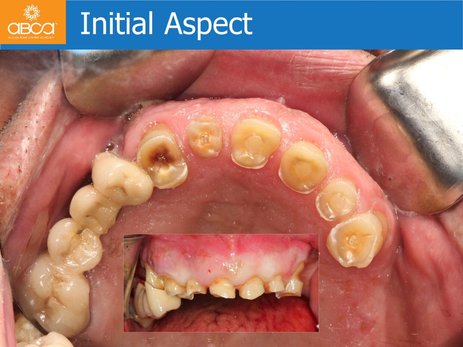 Complete Oral Rehabilitation Part 2-Maxillary Augmentation - Augma ...