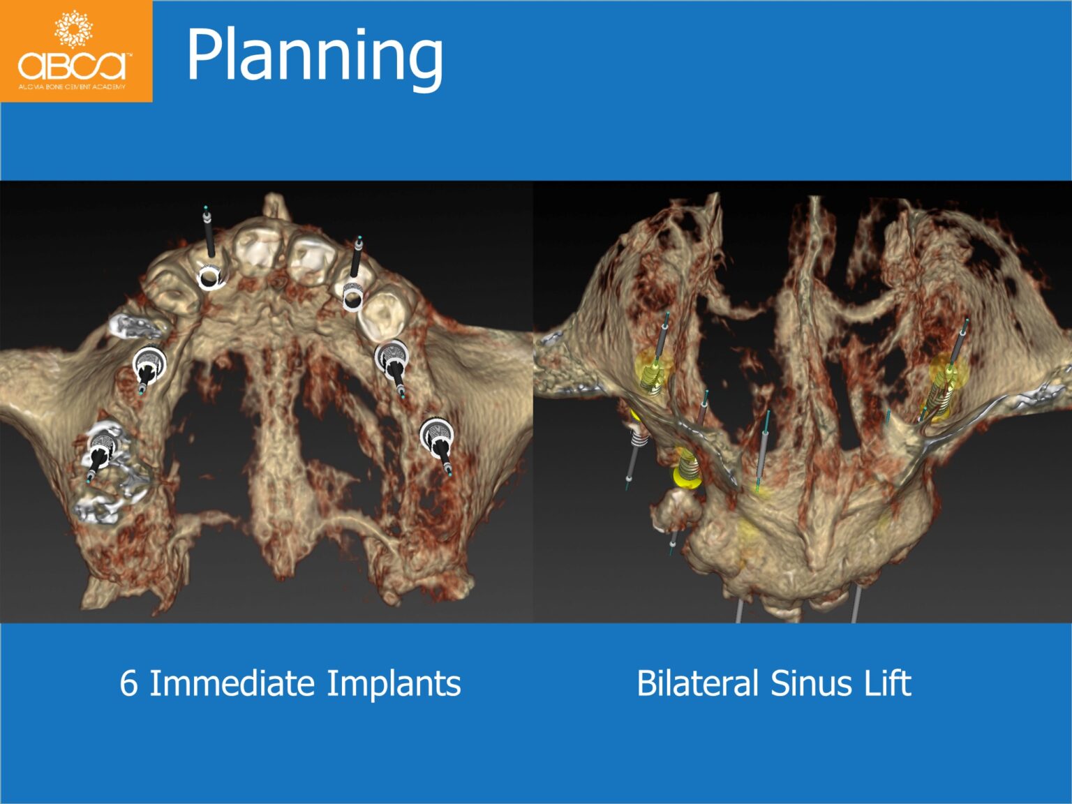 Complete Oral Rehabilitation Part 2-Maxillary Augmentation - Augma ...