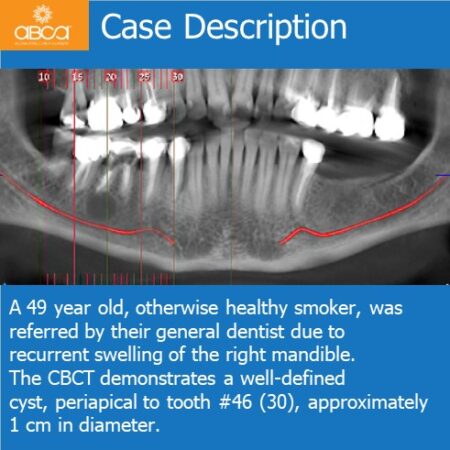 Cyst Enucleation, Augma & Implants - Augma Biomaterials