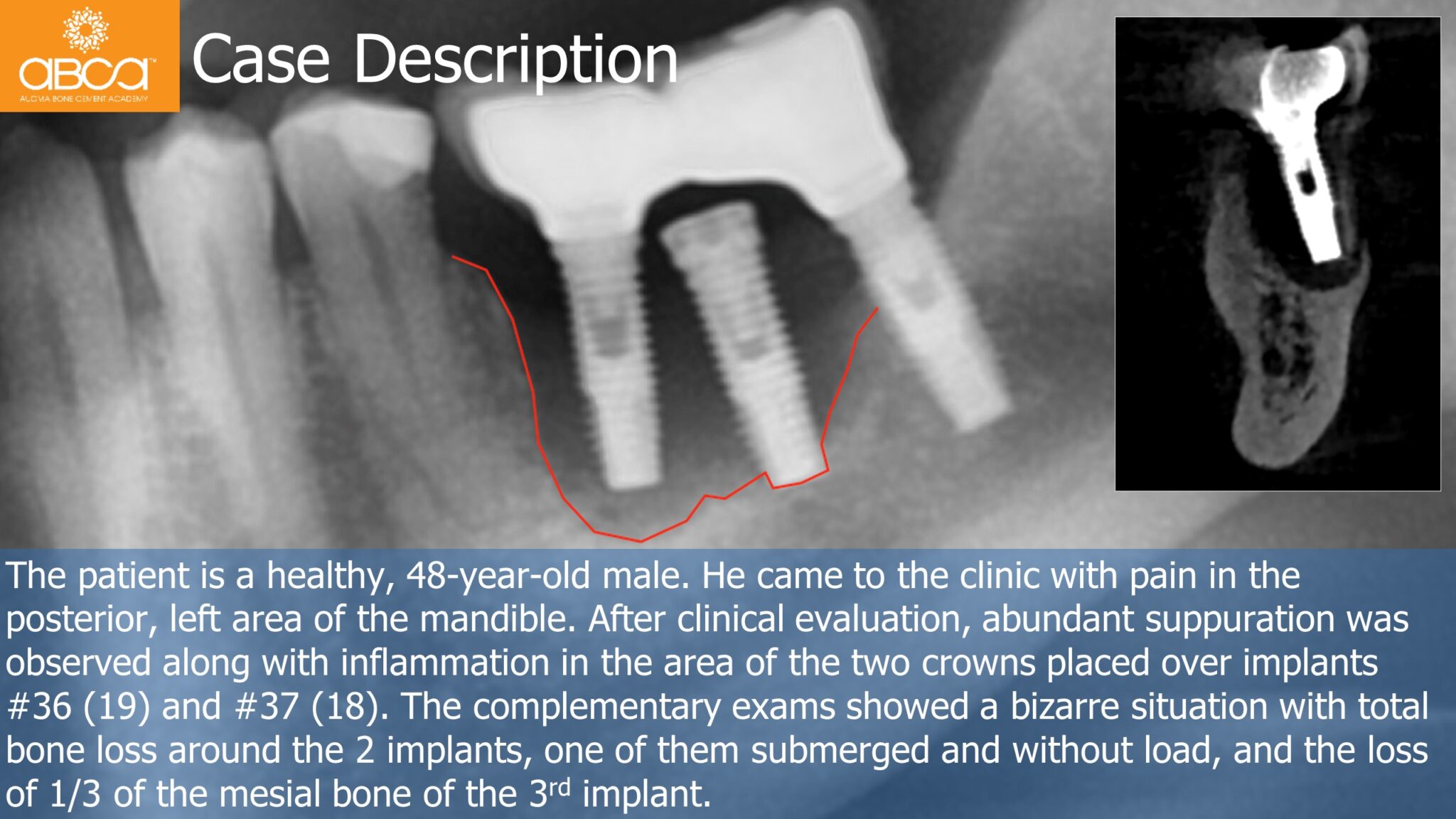 Rehabilitation of Large Bone Defect in the Left Posterior Part of the ...