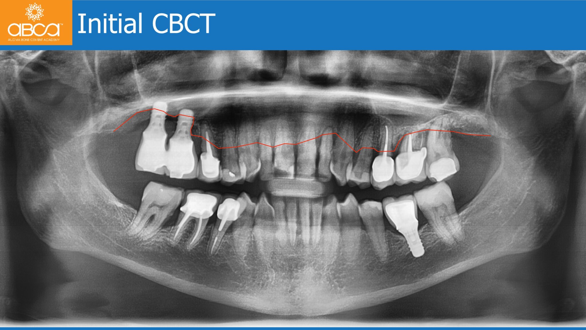 Maxillary Rehabilitation with Immediate All-on-4 - Augma Biomaterials
