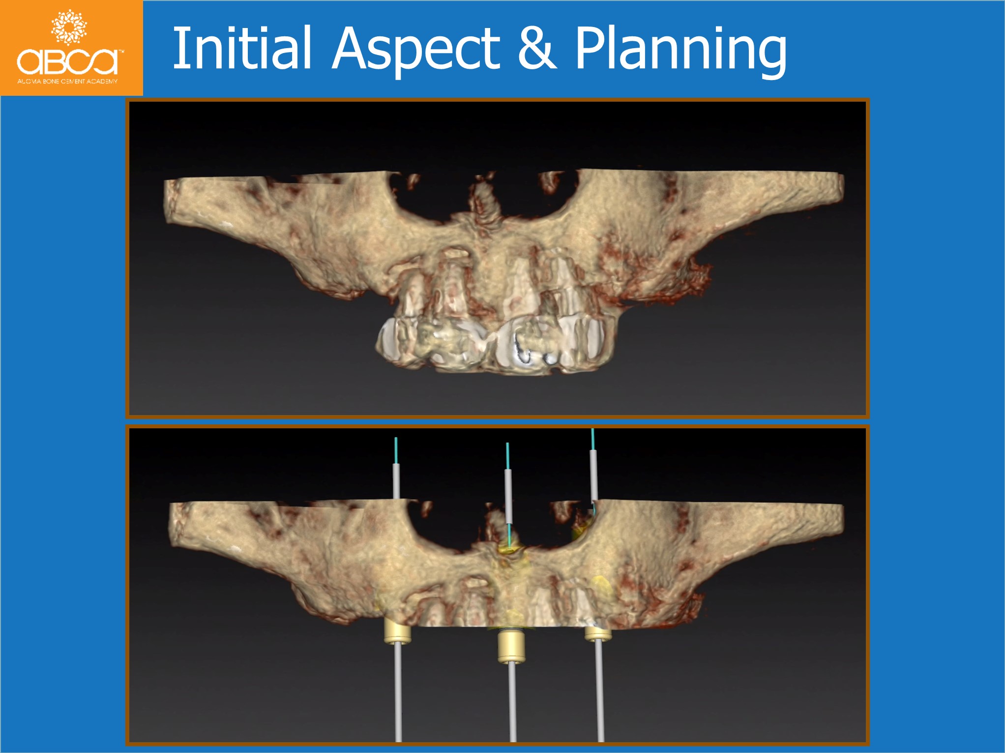 Maxillary Rehabilitation with Locaters Abutments - Augma Biomaterials