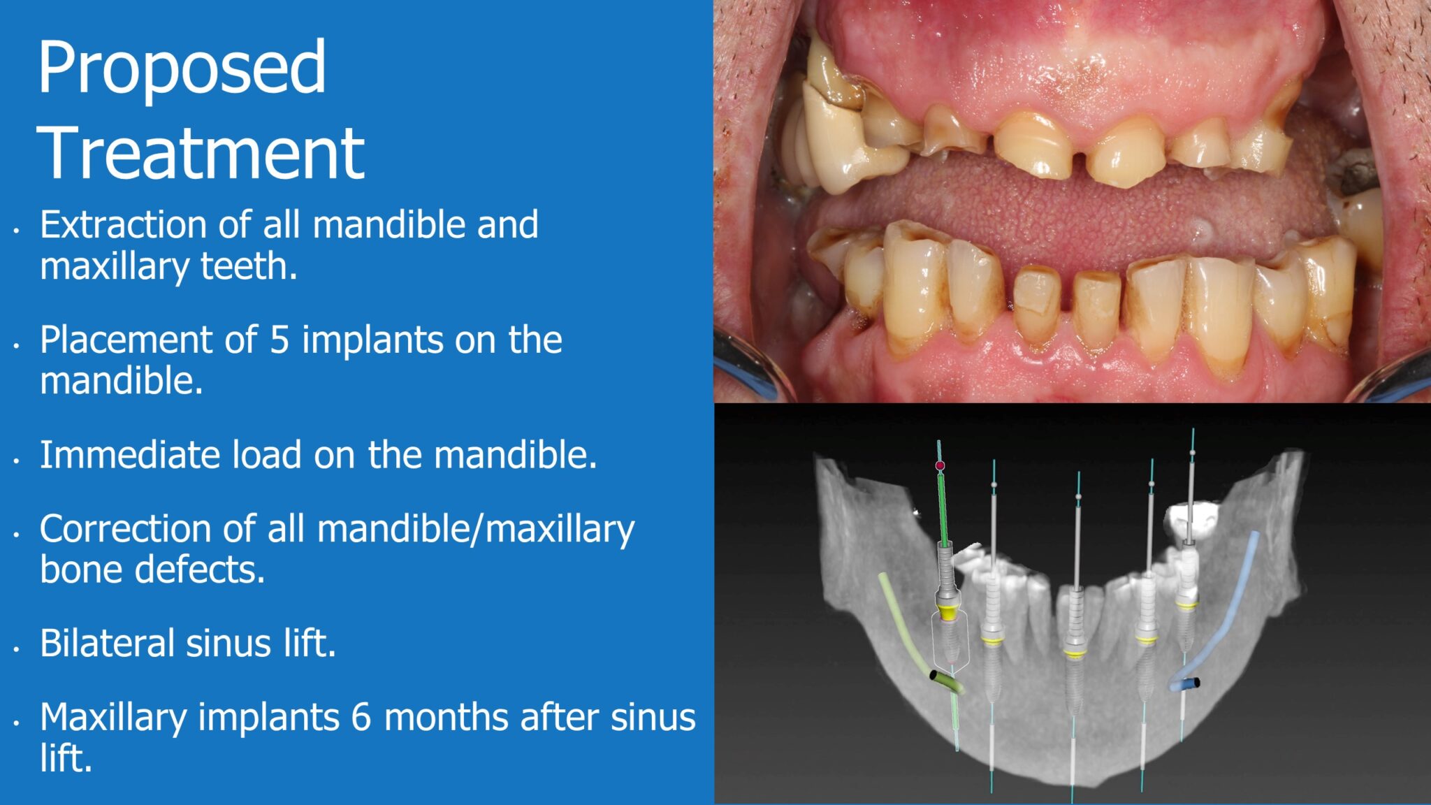 Complete Oral Rehabilitation Part 1-Mandible - Augma Biomaterials