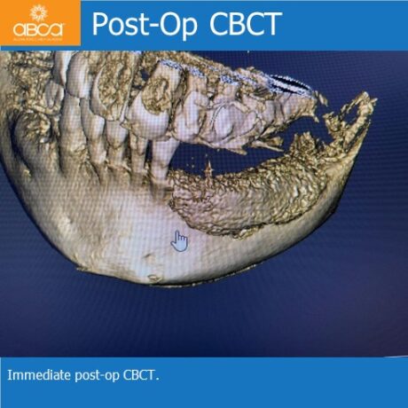Lateral Augmentation in Mandibular Atrophy - Augma Biomaterials