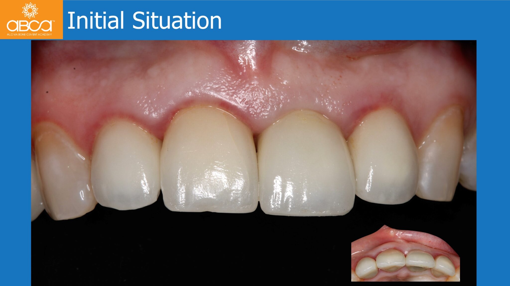 Immediate Implant of the Left Central Incisor Using the PET Technique ...