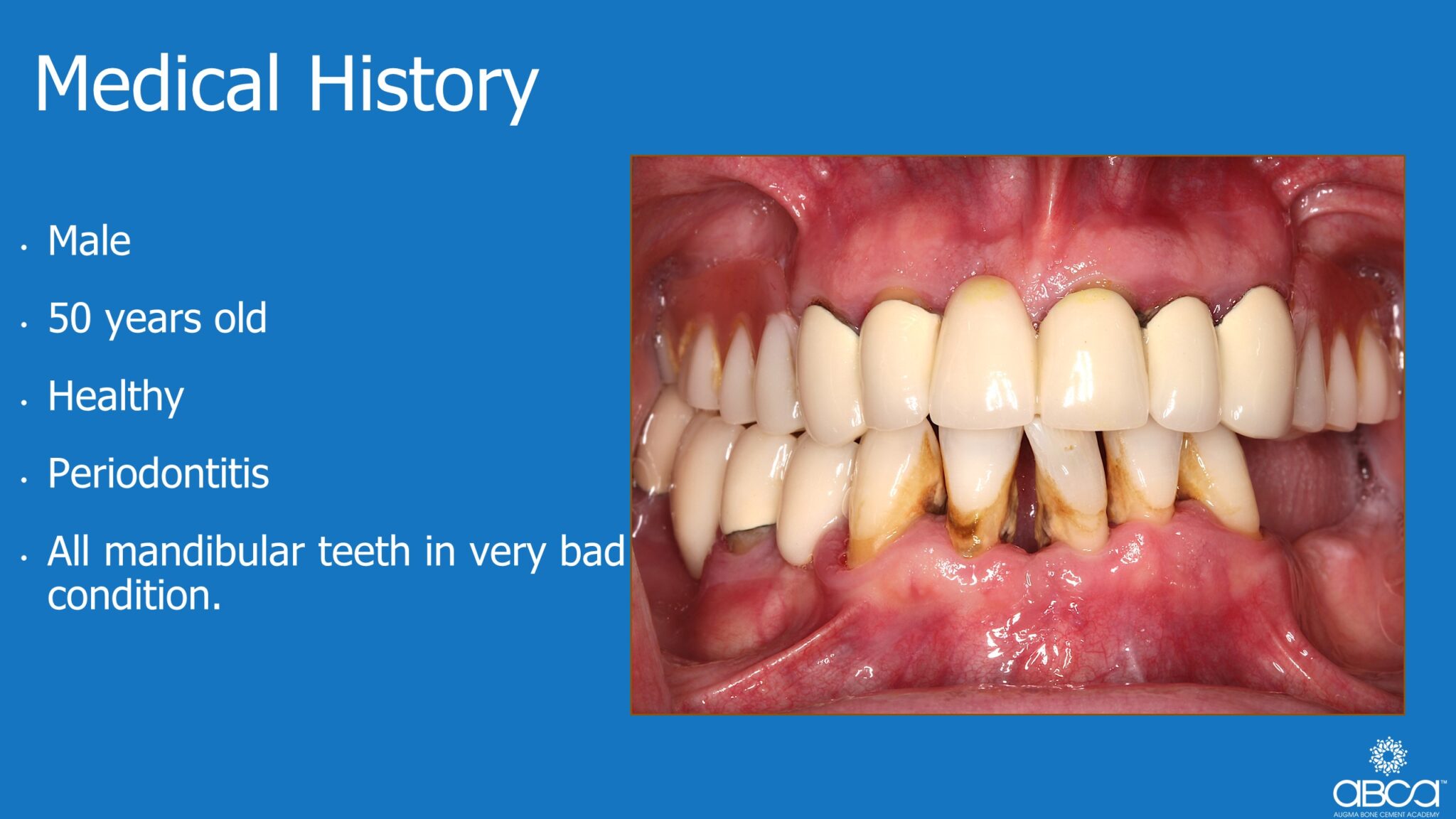 Two Stage Mandible Rehabilitation - Augma Biomaterials
