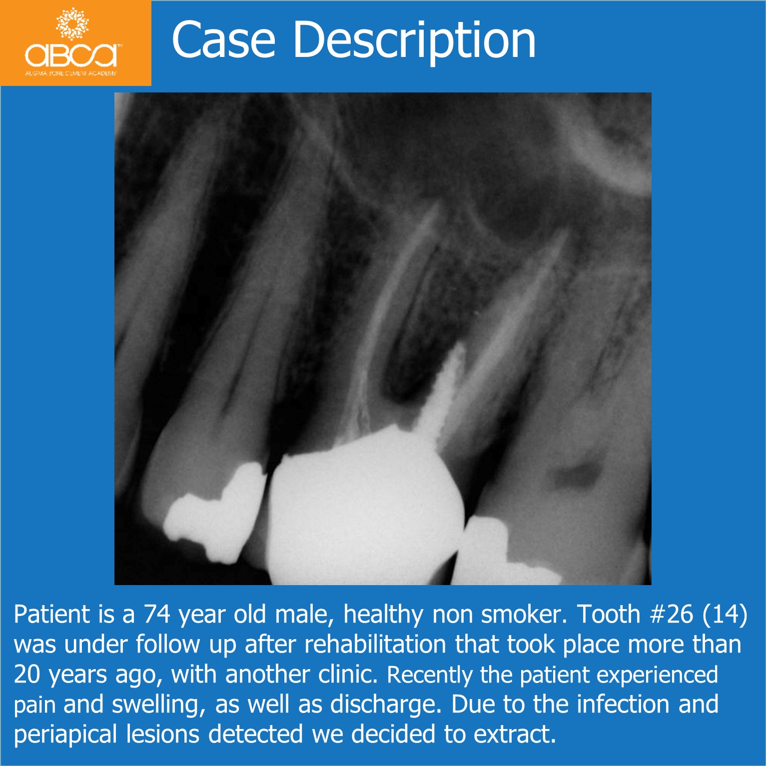 Single Tooth Loss Beneath the Maxillary Sinus - Augma Biomaterials
