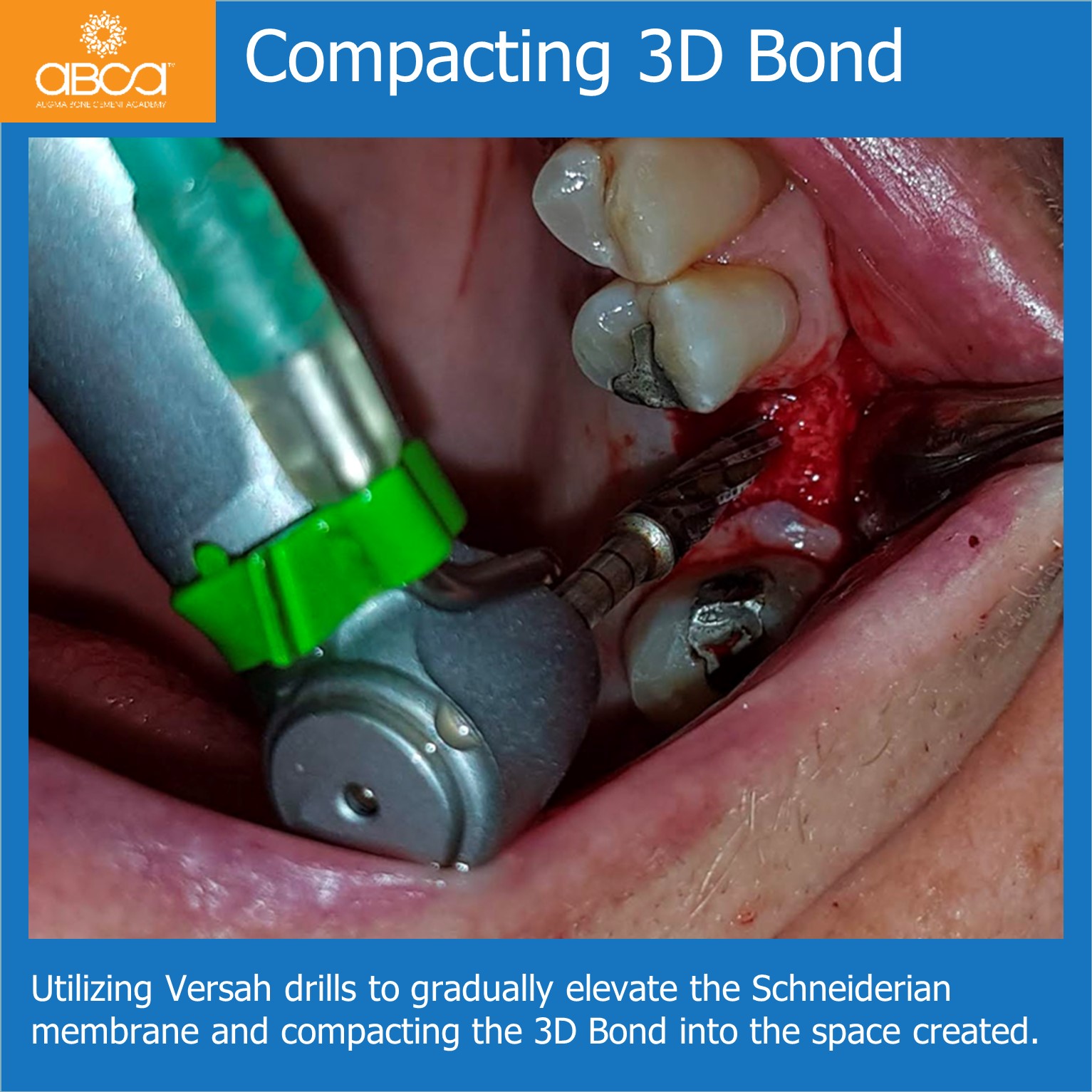 Single Tooth Loss Beneath the Maxillary Sinus - Augma Biomaterials