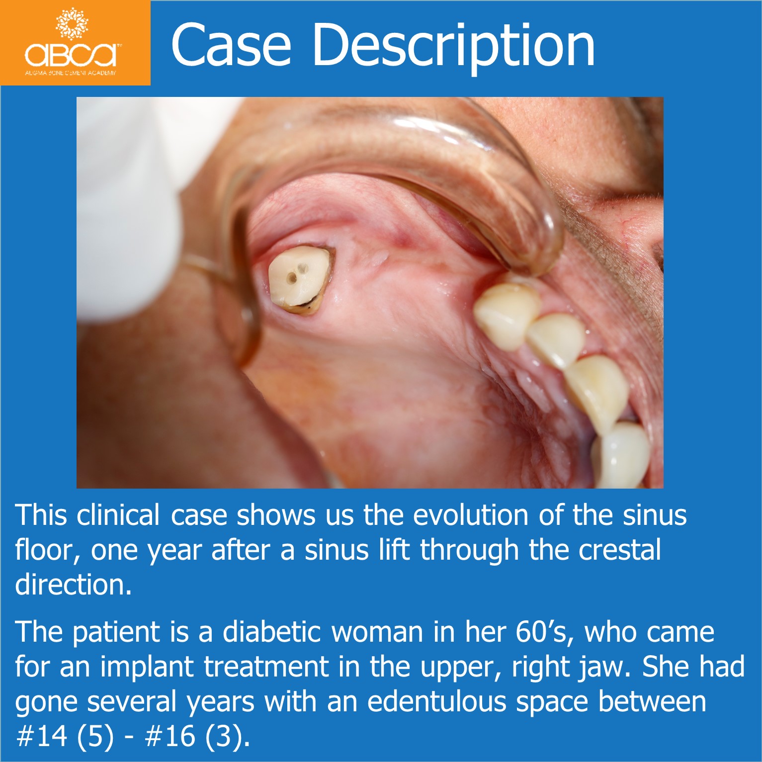 Closed Sinus Lift - Augma Biomaterials