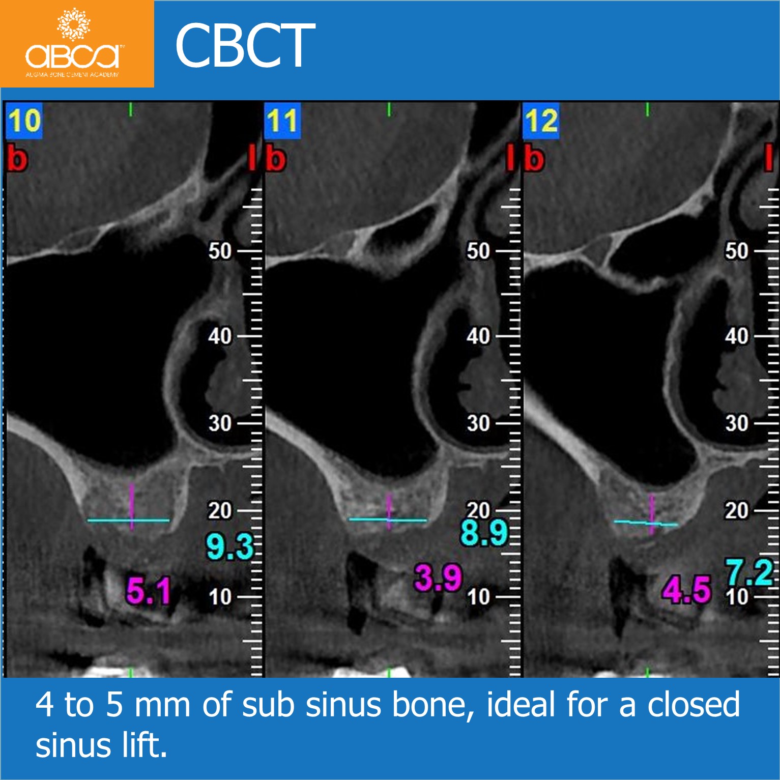 Closed Sinus Lift - Augma Biomaterials