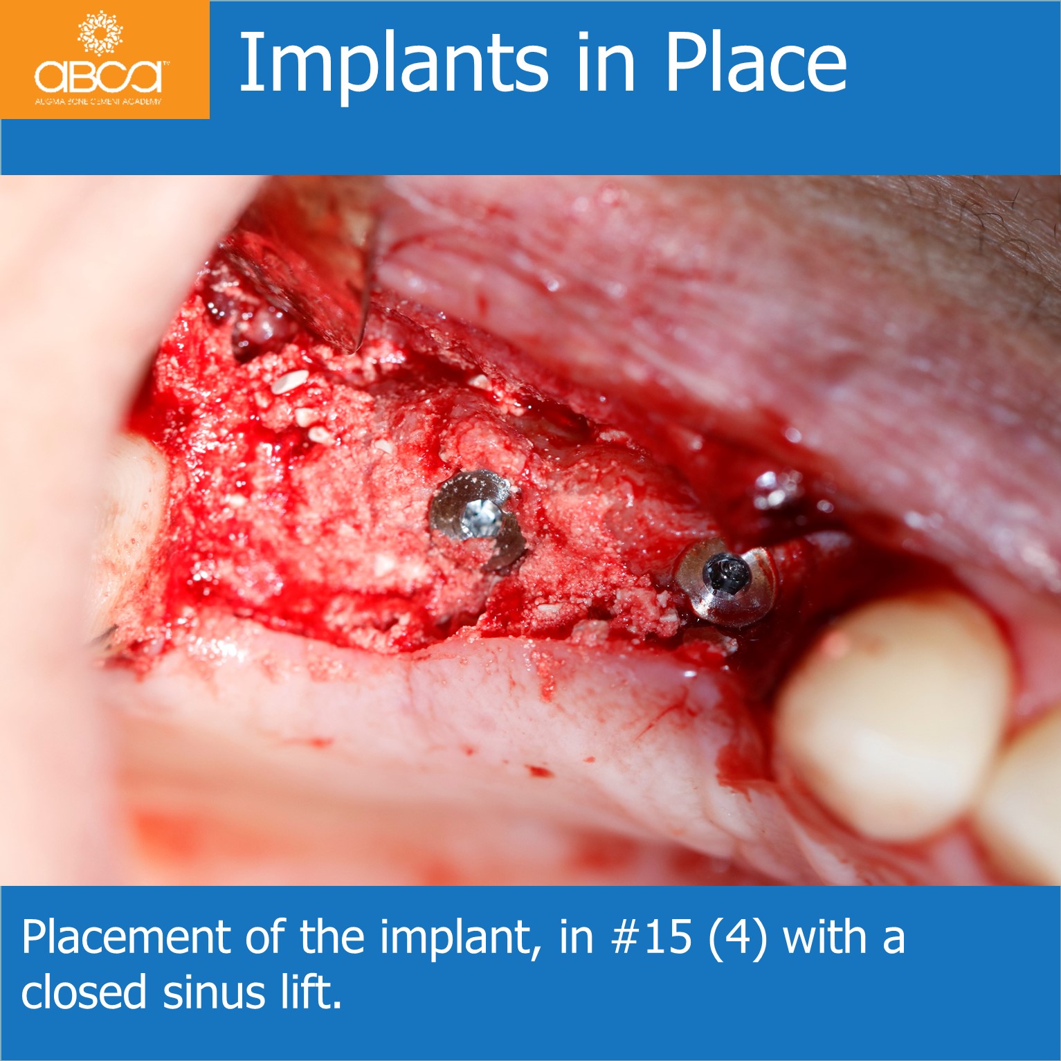 Closed Sinus Lift - Augma Biomaterials