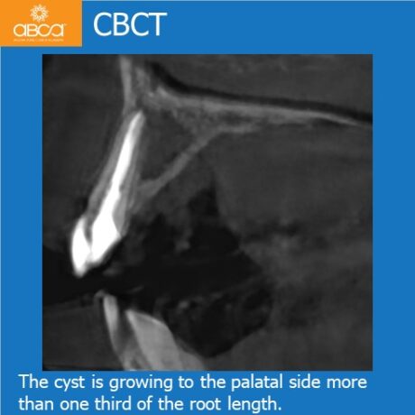 Cyst of the Anterior Left Maxilla - Augma Biomaterials