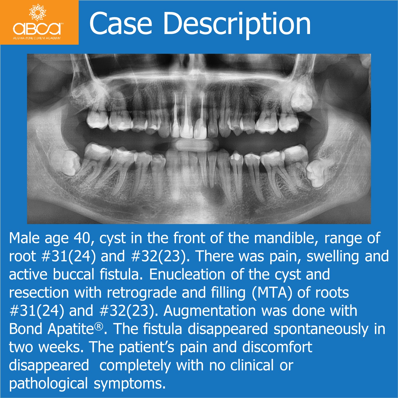Large Cyst Enucleation, Apicoectomy with MTA Retrograde Filling and ...