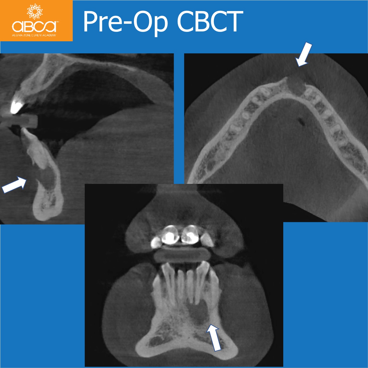 Large Cyst Enucleation, Apicoectomy with MTA Retrograde Filling and ...