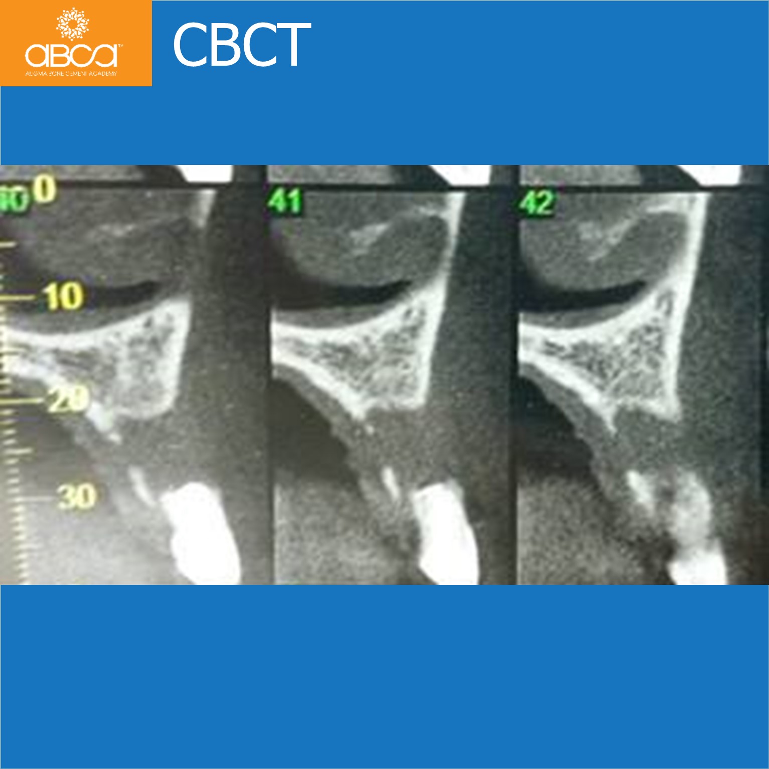 Socket Grafting & Cyst Removal - Augma Biomaterials