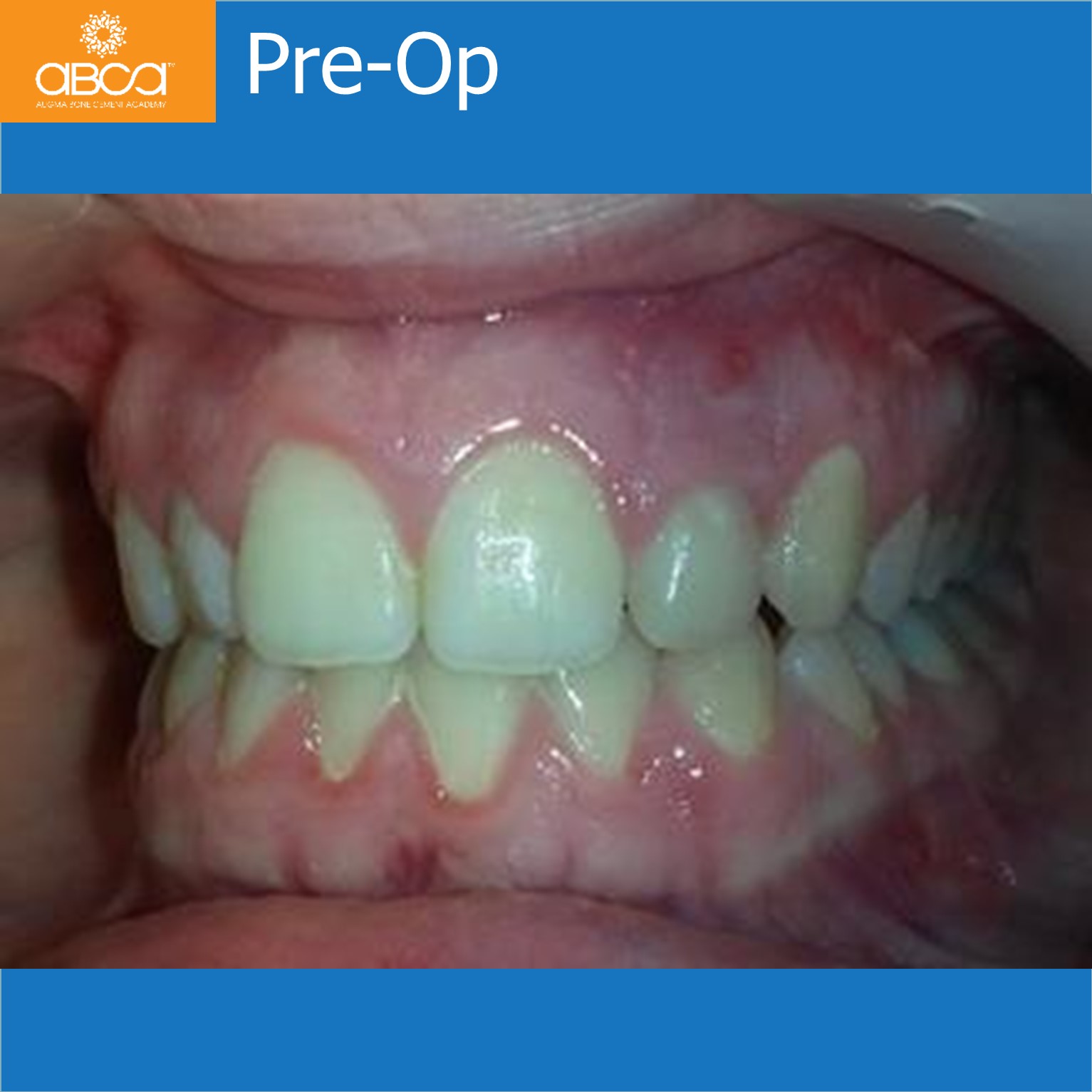 Socket Grafting & Cyst Removal - Augma Biomaterials