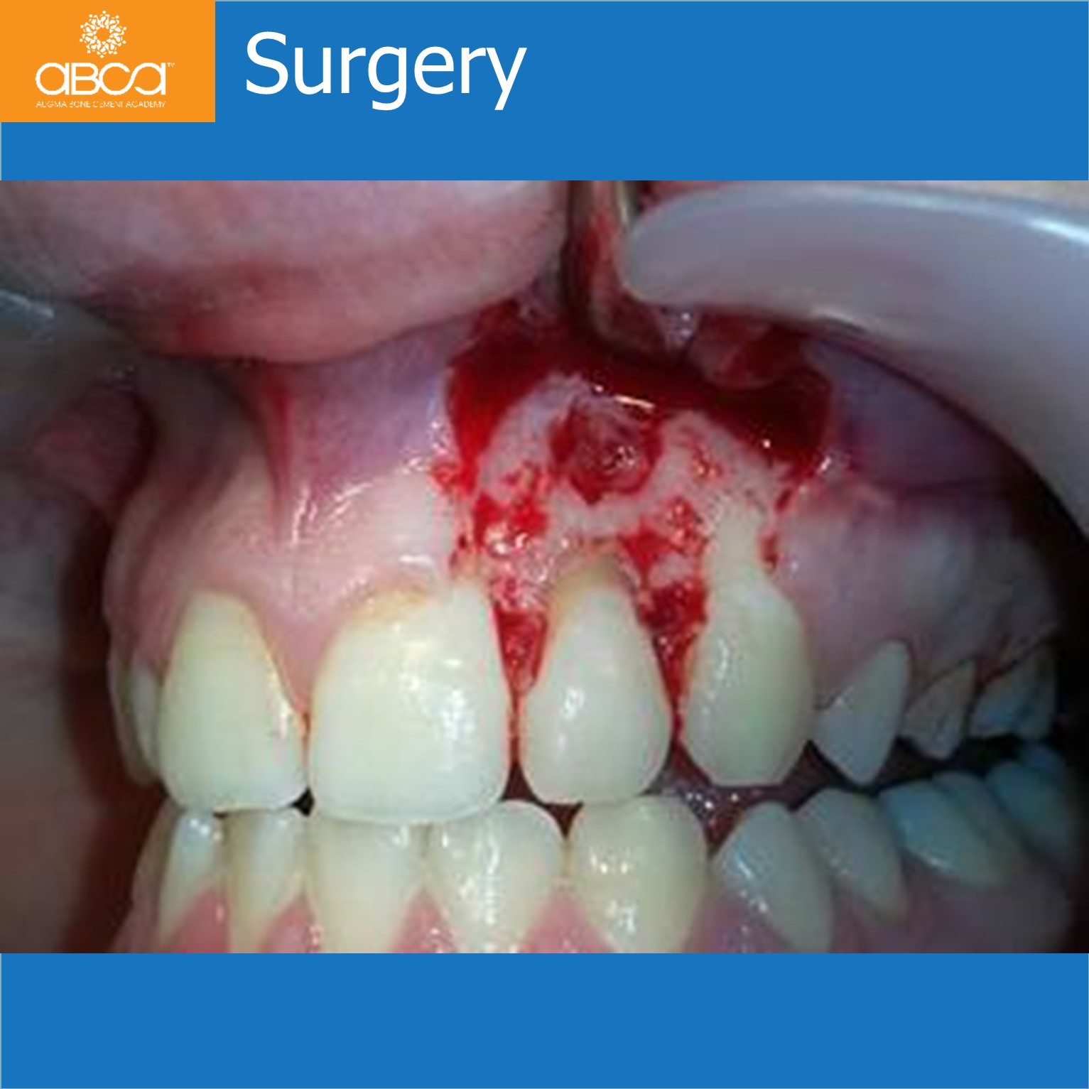 Socket Grafting & Cyst Removal - Augma Biomaterials