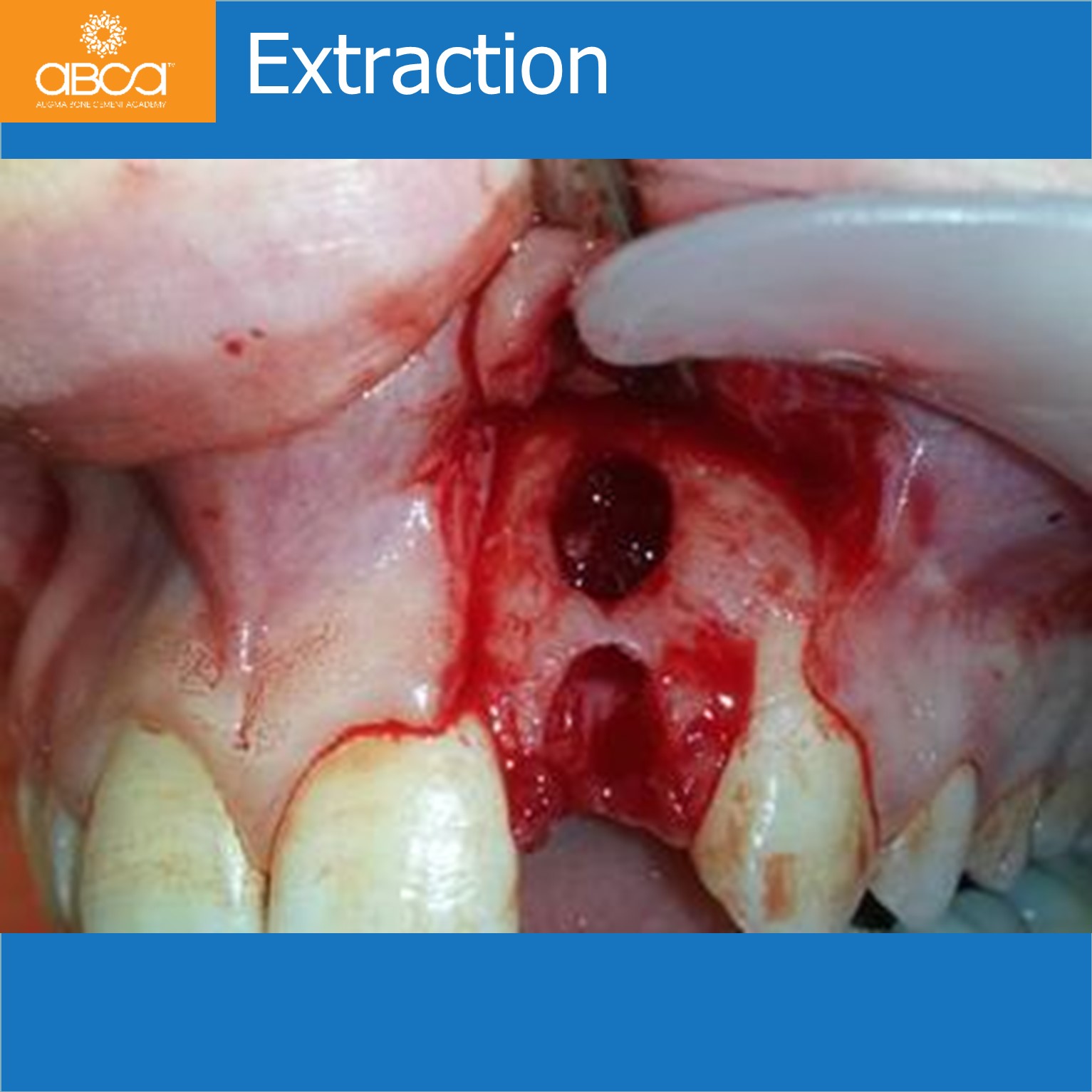 Socket Grafting & Cyst Removal - Augma Biomaterials