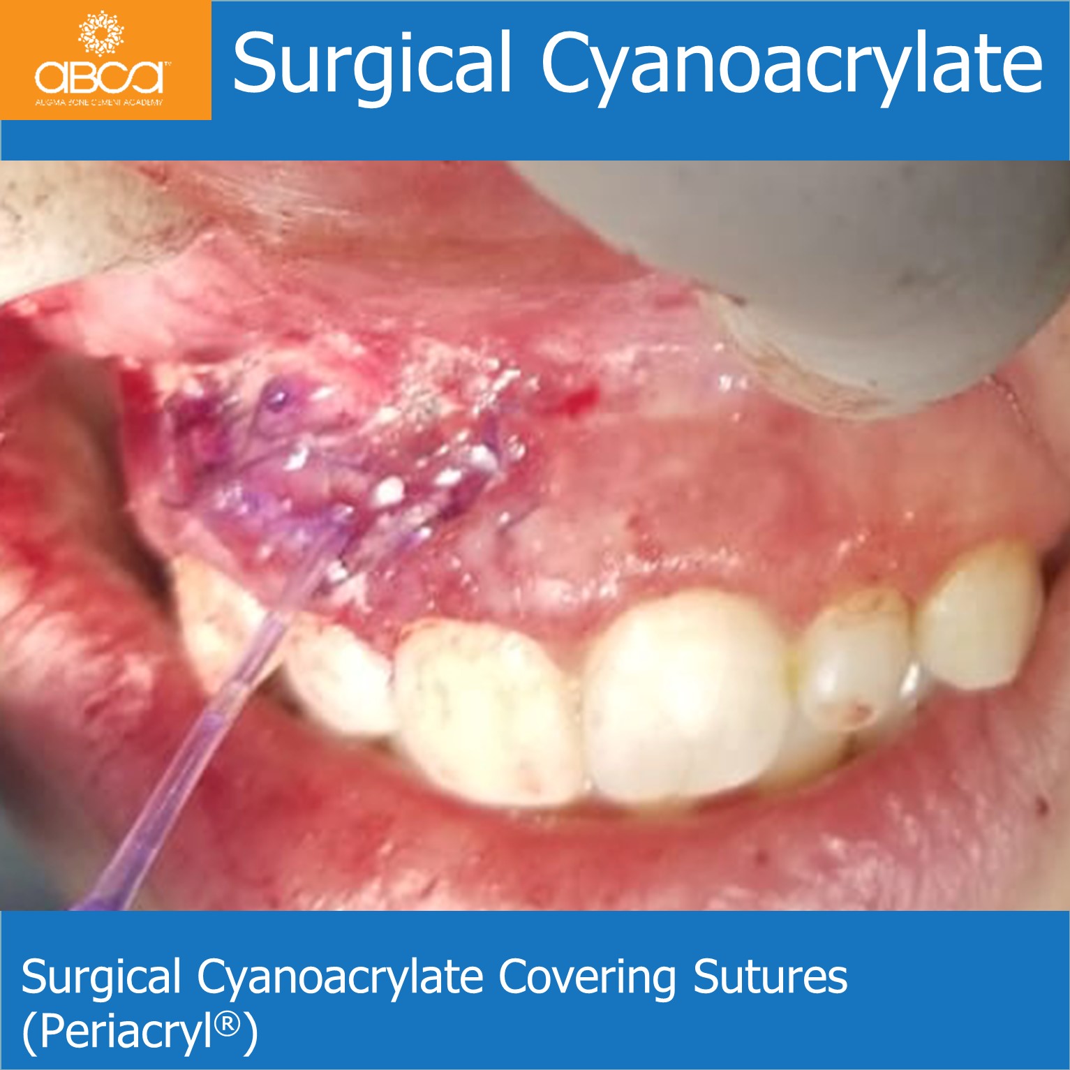 Large Cyst Augmentation with Bond Apatite® - Augma Biomaterials