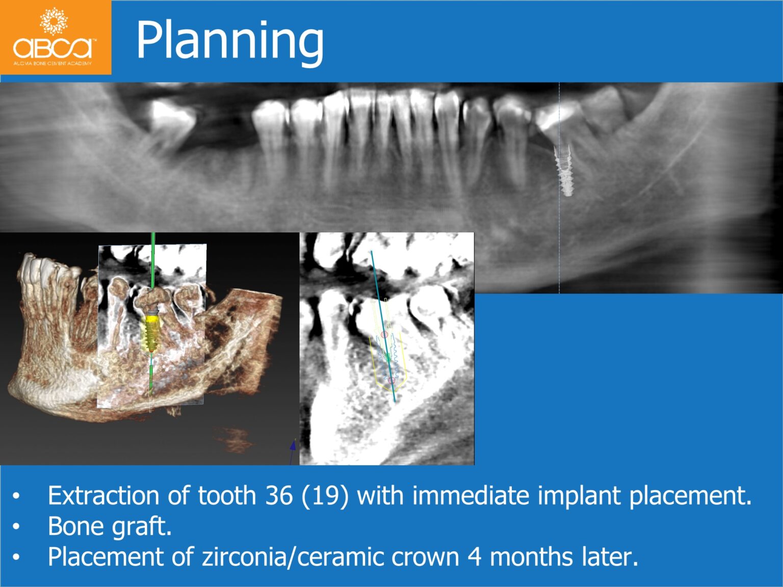 Immediate Posterior Implant with Bone Graft - Augma Biomaterials