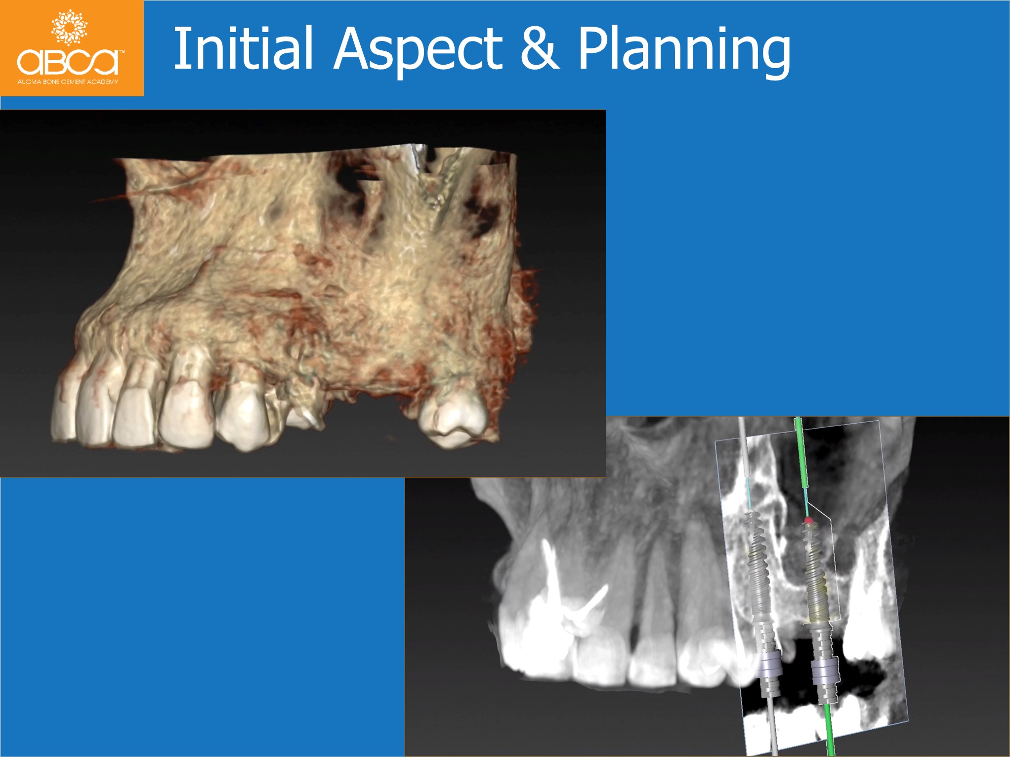 Sinus Lift with Immediate Implant Placement - Augma Biomaterials