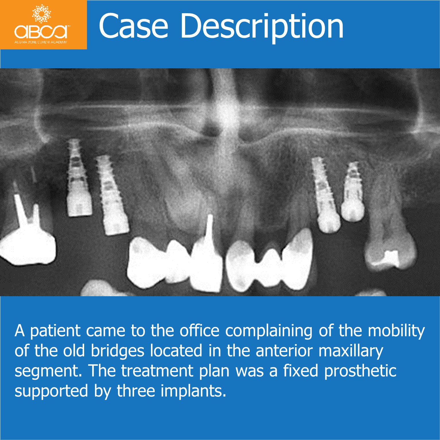 Mobility of Old Bridges in the Anterior Maxillary - Augma Biomaterials