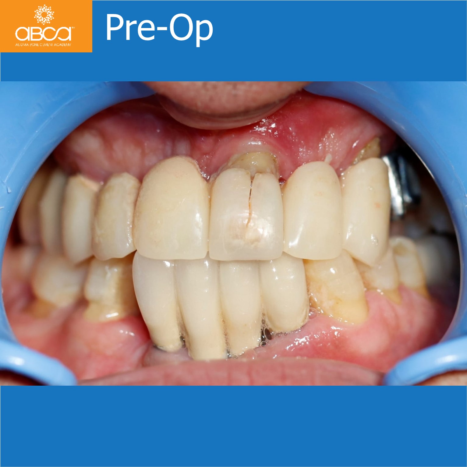 Mobility of Old Bridges in the Anterior Maxillary - Augma Biomaterials