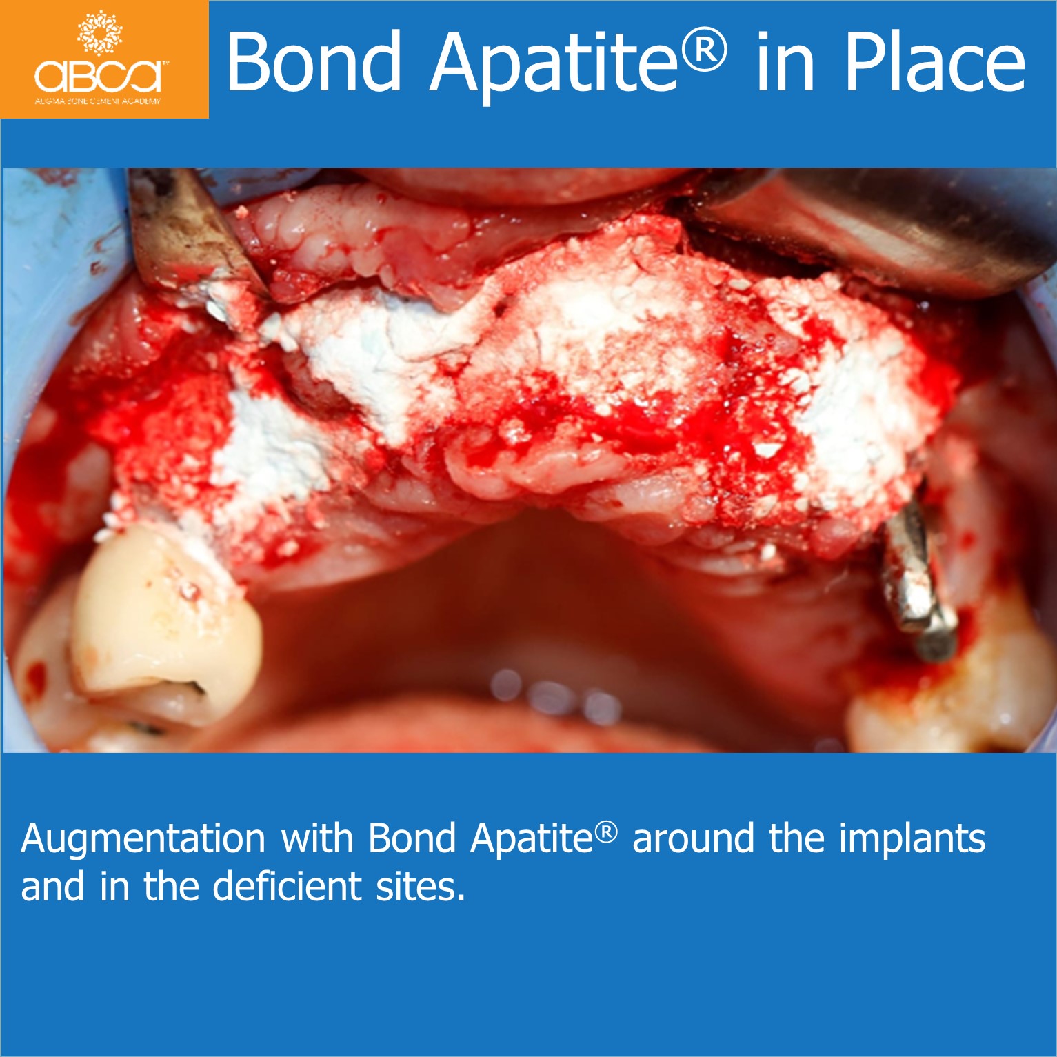 Mobility of Old Bridges in the Anterior Maxillary - Augma Biomaterials