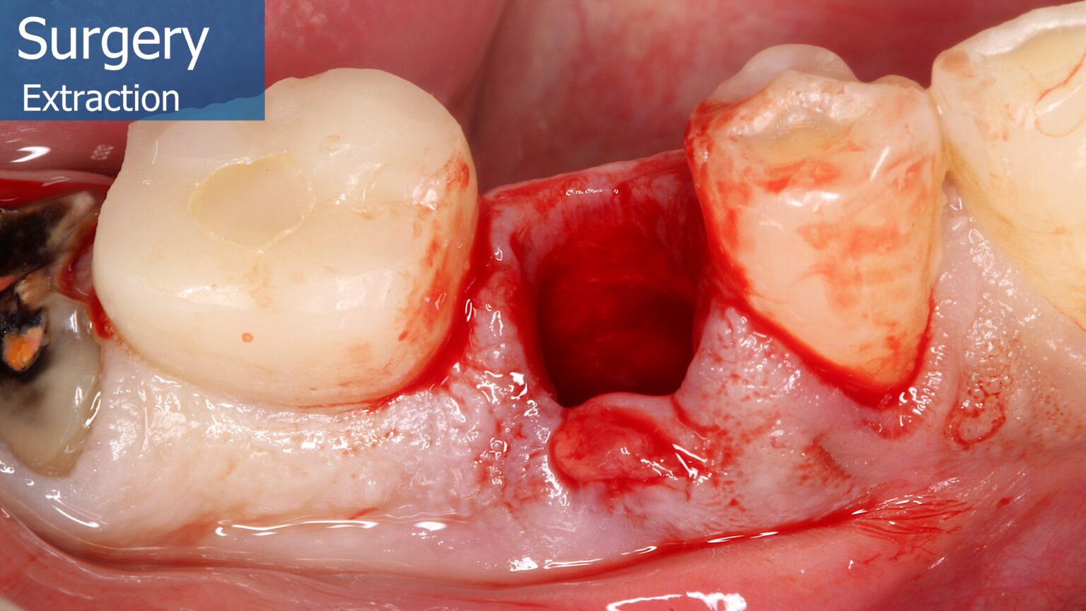 Premolar Extraction with Bone Graft and Immediate Implant - Augma ...