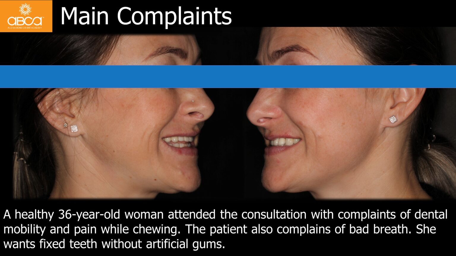 Total Maxillary Rehabilitation in Two Phases with Bone Reconstruction ...